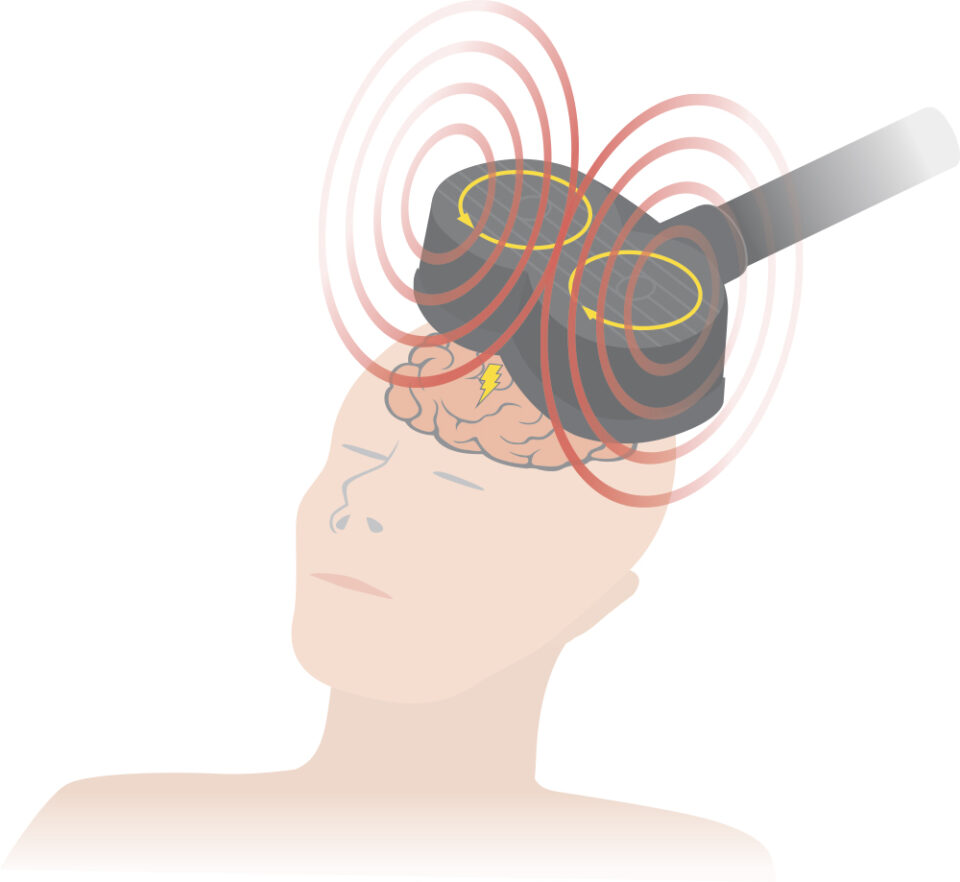 Region Midtjylland har stor succes med TMS-behandling af depression ...